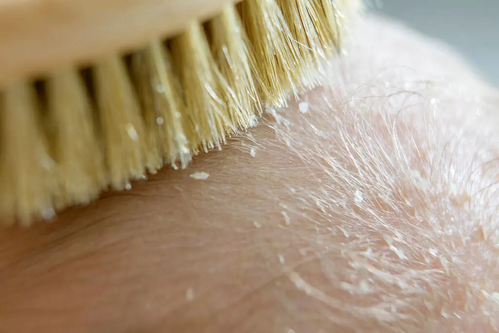 Ciemieniucha u dzieci – objawy i leczenie - aptelia.pl